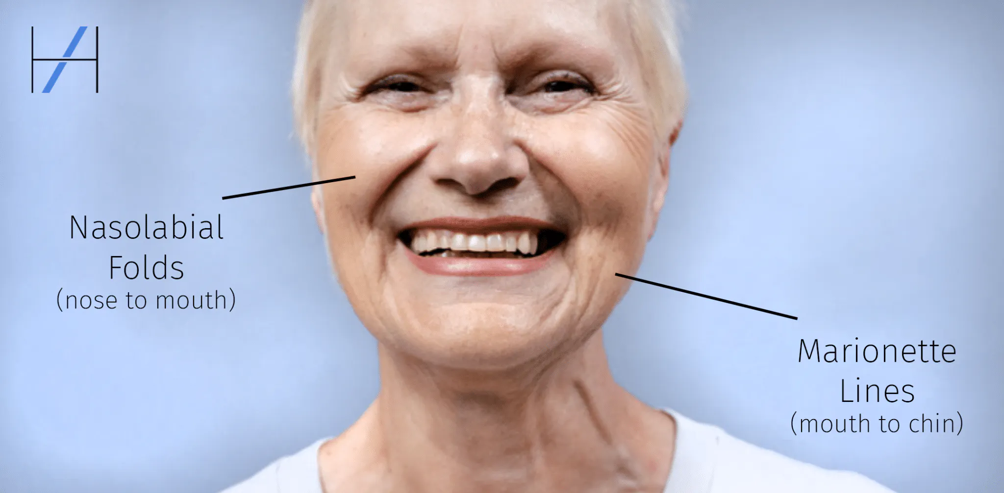 Mastering Marionette Line Filler Treatments | Harley Academy