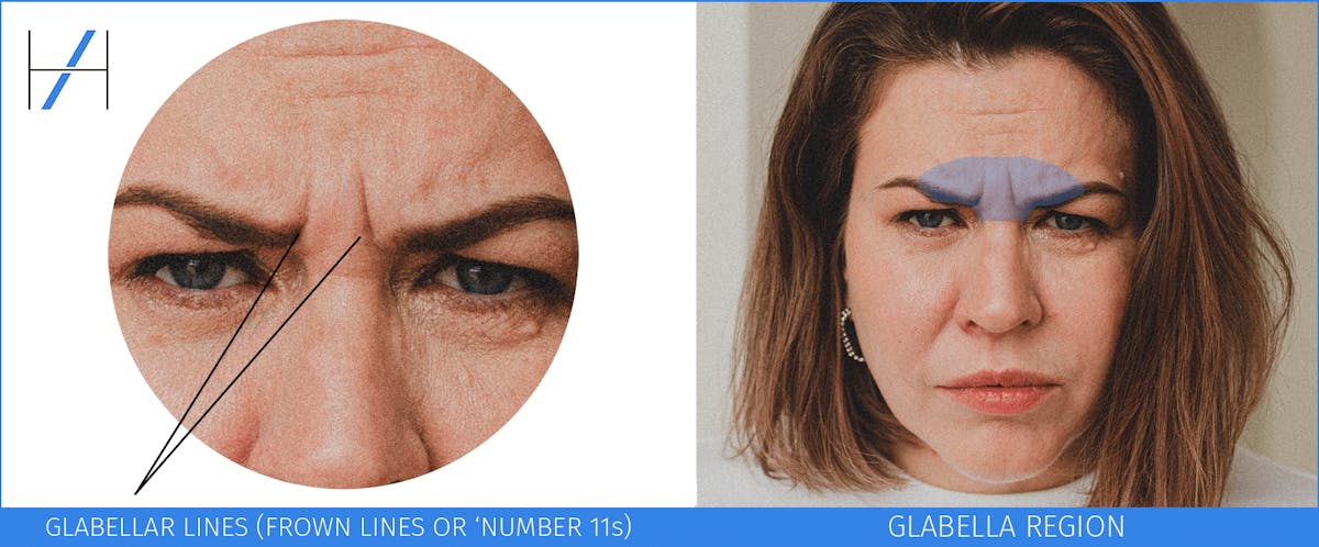 Understanding Glabellar Line Treatment | Harley Academy