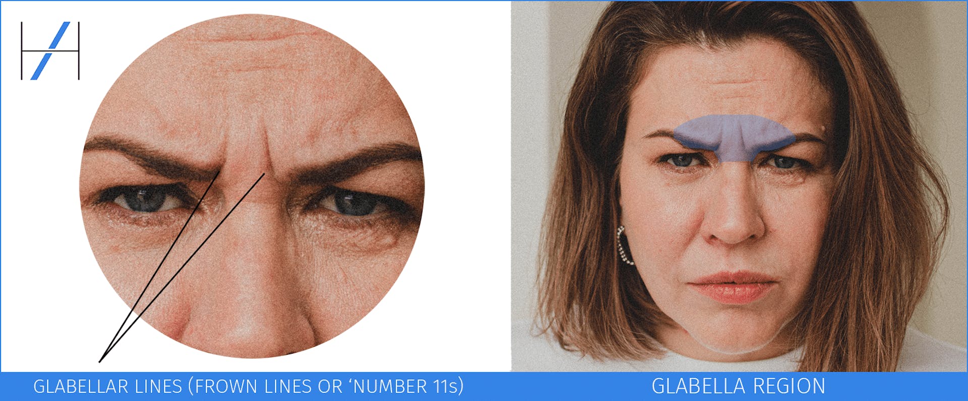 Understanding Glabellar Line Treatment | Harley Academy