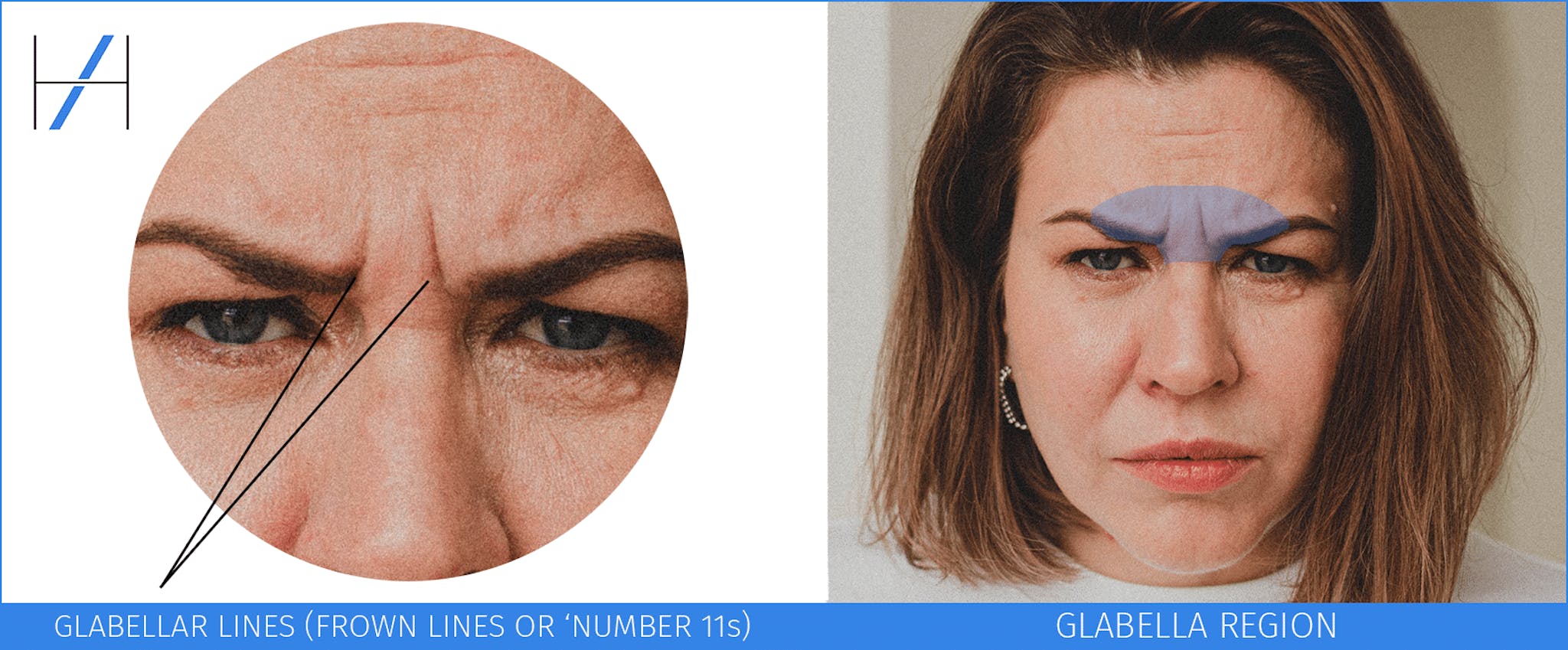 Understanding Glabellar Line Treatment | Harley Academy