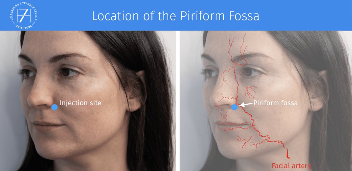 Expert advice on Injecting the Piriform Fossa