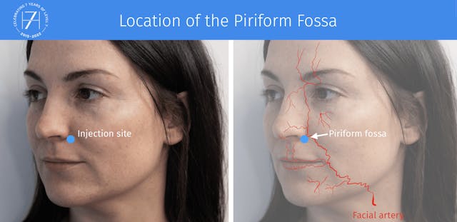 Expert advice on Injecting the Piriform Fossa