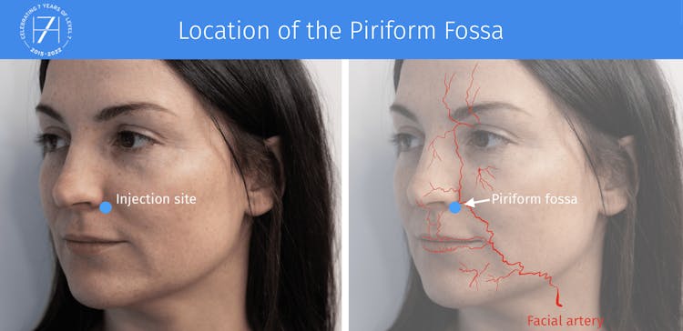Expert advice on Injecting the Piriform Fossa