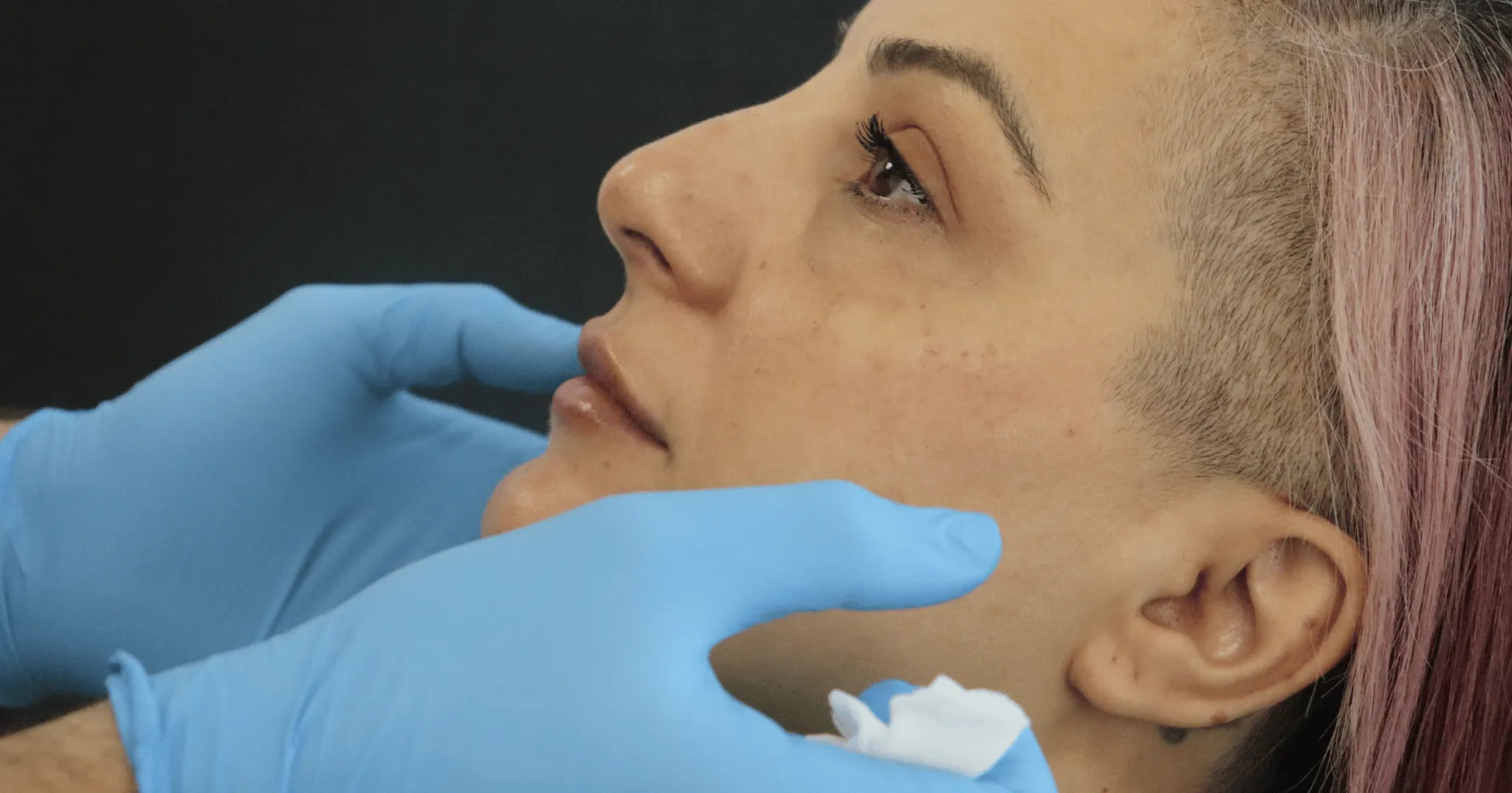 Advice on dealing with Palpable Filler