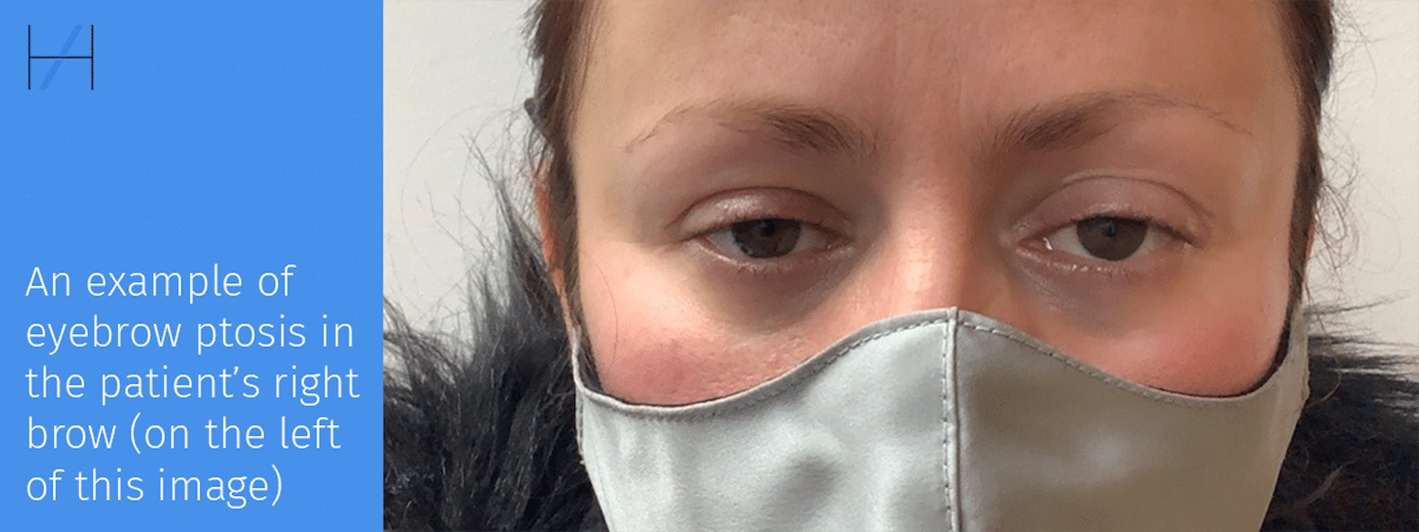 How to tell Eyebrow Ptosis from Lid Ptosis