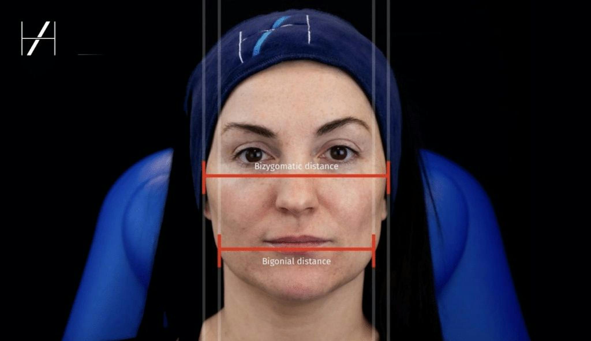 Cheek Filler and Facial Shape Considerations | Harley Academy