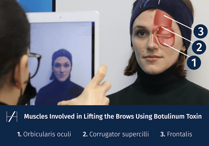 Botox Brow Lift injecting techniques