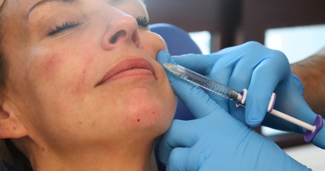 How to Treat Nasolabial Folds with Filler: Specialist Advice