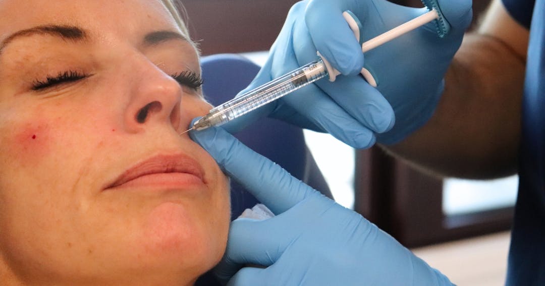 How to Treat Nasolabial Folds with Filler: Specialist Advice