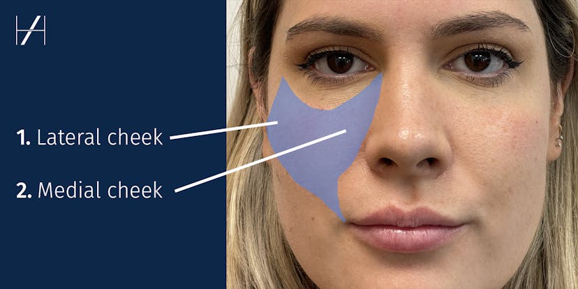 Cheek Filler Techniques: Medial V Lateral Treatments | Harley Academy