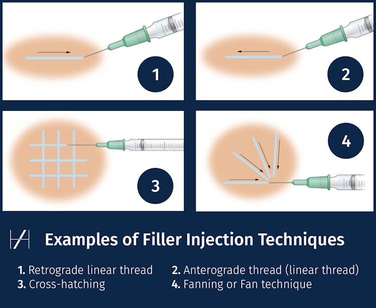 4 Essential Dermal Filler injecting techniques