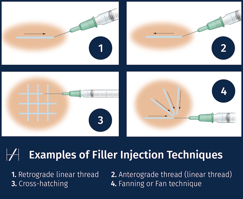 4 Essential Dermal Filler injecting techniques