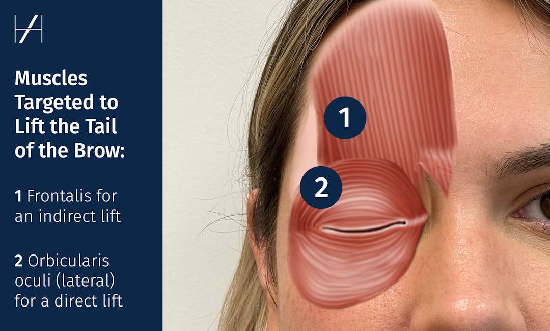How to lift the tail of the Brow with Botulinum Toxin