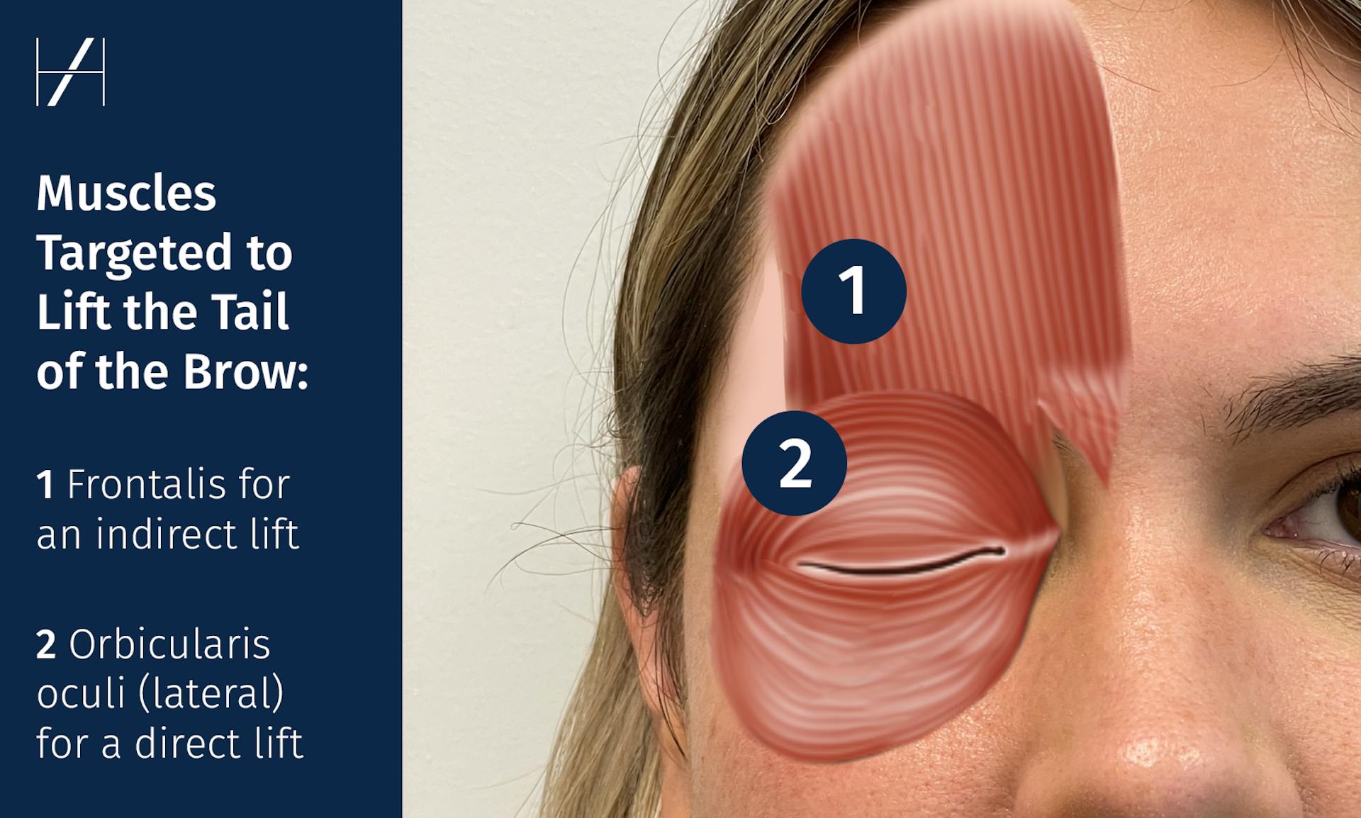 How to lift the tail of the Brow with Botulinum Toxin