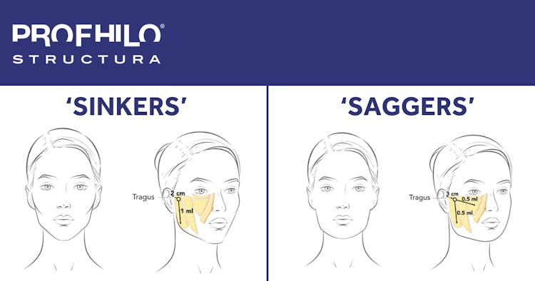 What is Profhilo Structura? New Regenerative Skin Injectable