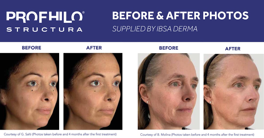 What is Profhilo Structura? New Regenerative Skin Injectable