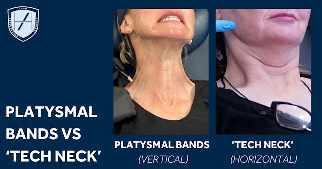 Specialist Advice on How to Treat Platysmal Bands | Harley Academy