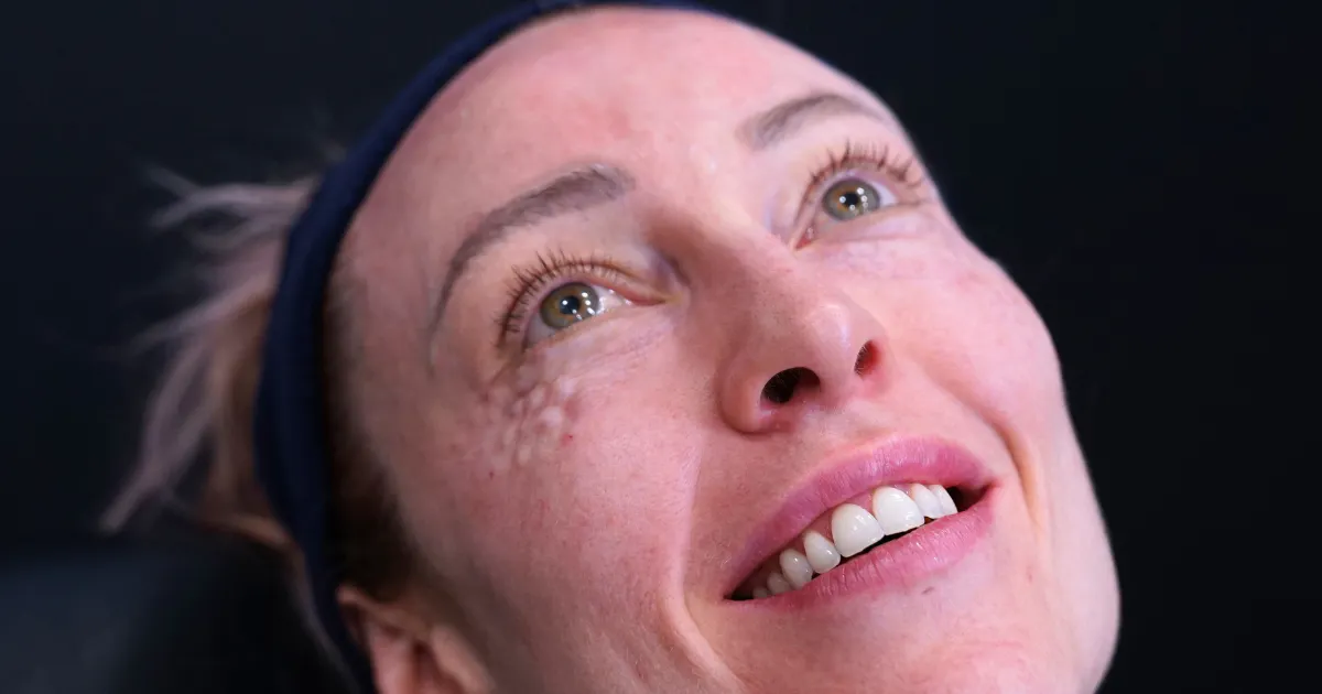 Guide to Polynucleotide Skin Boosters for Aesthetic Practitioners