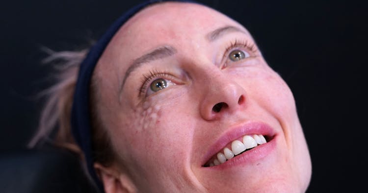 What is Jelly Roll Botox? A Guide for Aesthetic Practitioners