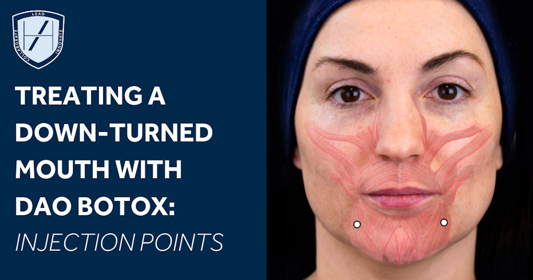 Treating a Down-Turned Mouth with Botox | Harley Academy
