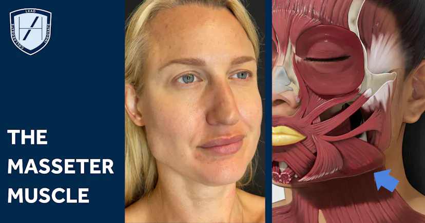 Masseter Botox Injection Techniques for Jawline Slimming | Harley Academy