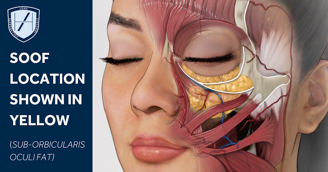 Treating the SOOF - Mid-Face Rejuvenation Techniques | Harley Academy