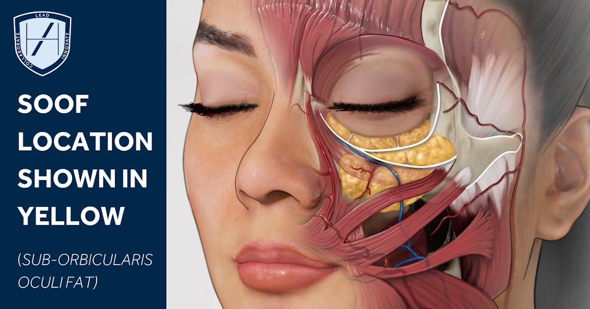 Treating the SOOF - Mid-Face Rejuvenation Techniques | Harley Academy
