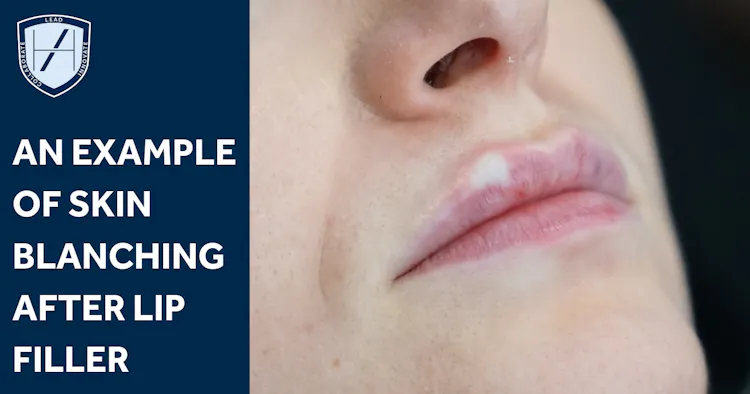 Blanching After Botox: Why It Can Happen and How to Manage It