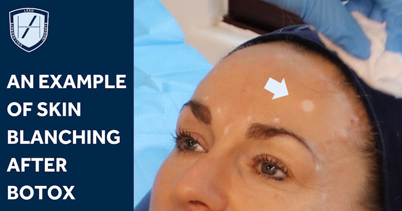 Blanching After Botox: Why It Can Happen and How to Manage It