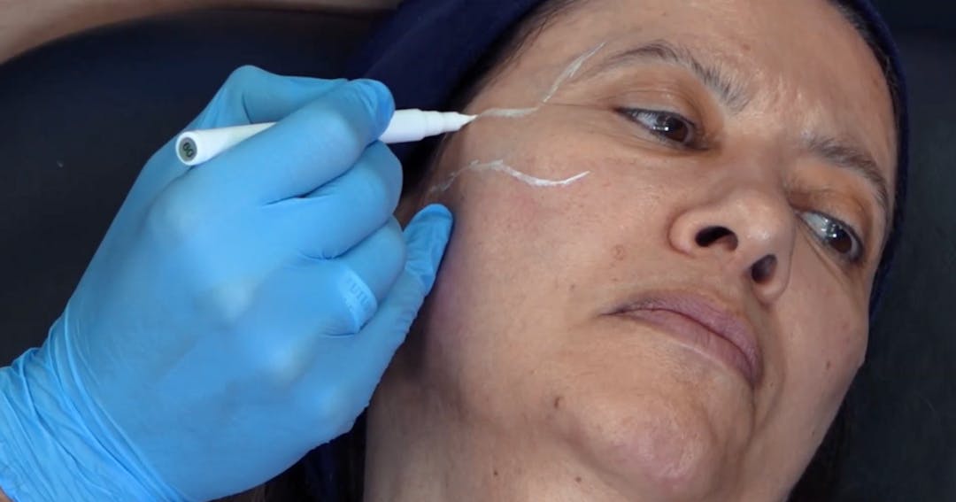 Marking Up For Cheek Filler | Harley Academy