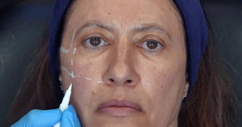 Marking Up For Cheek Filler | Harley Academy