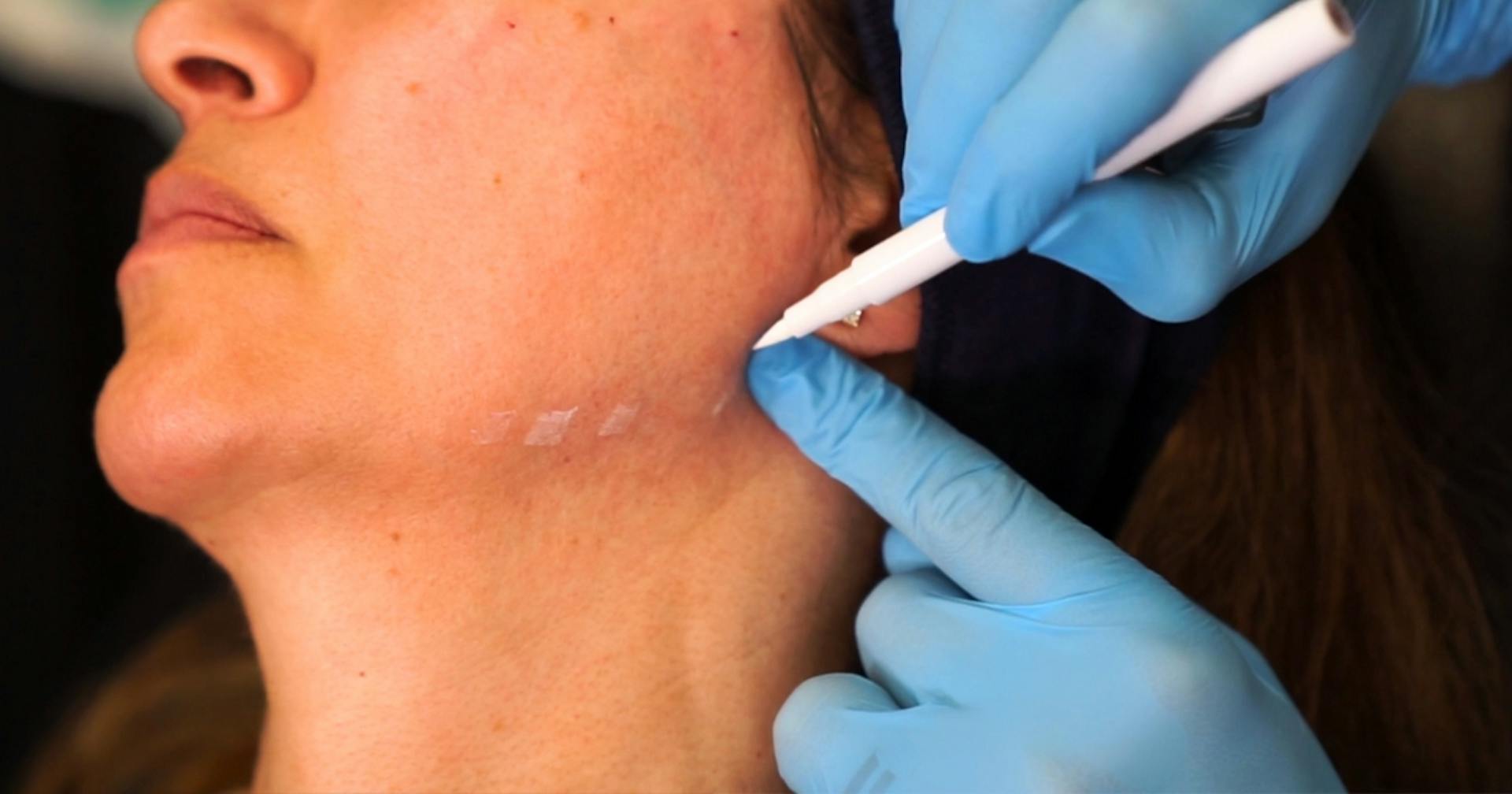 Jawline Contouring: How to Prevent Lower Face Filler Complications