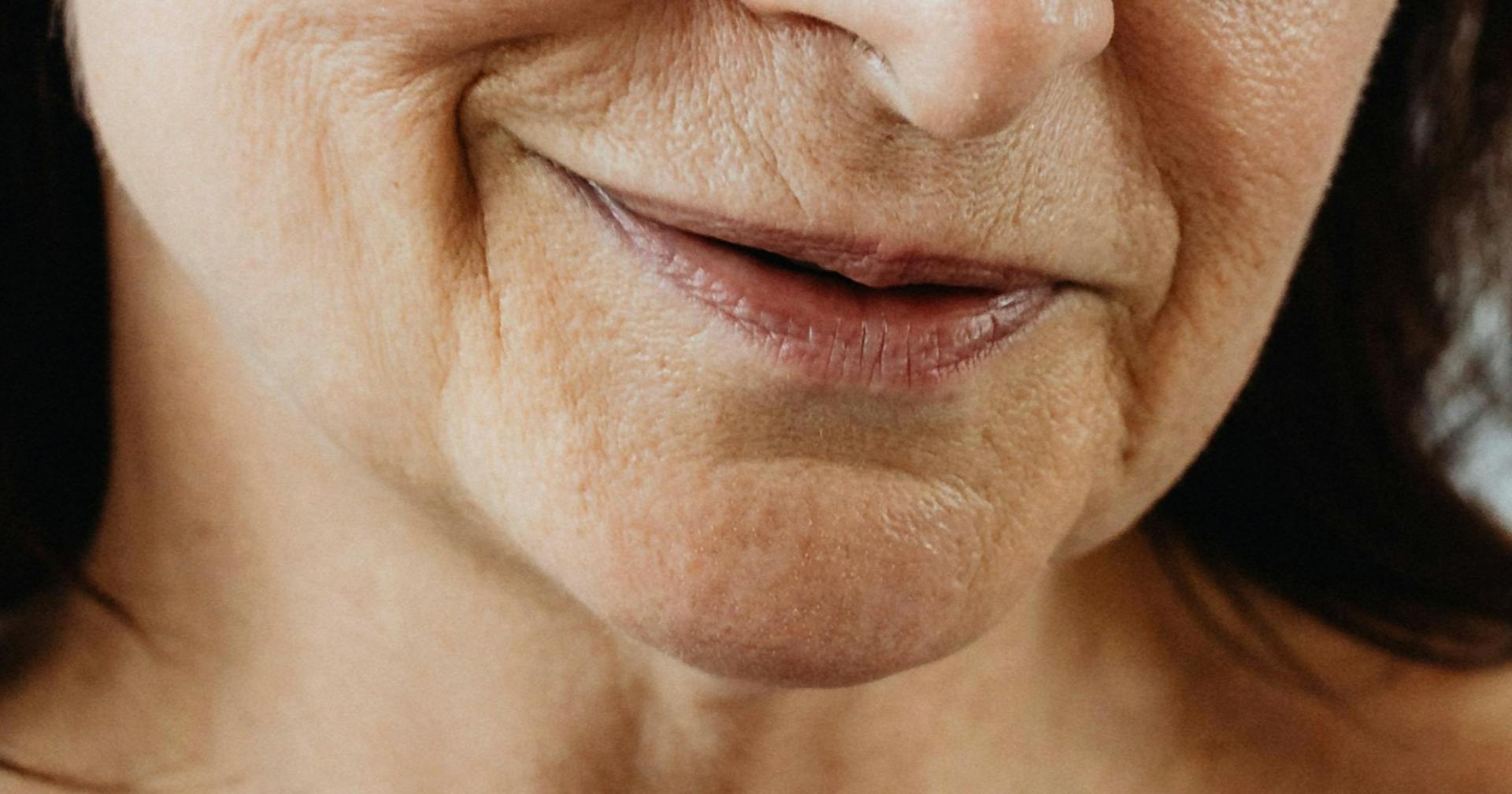 Chin Botox: Treating the Mental Crease & Preventing Upwards Rotation