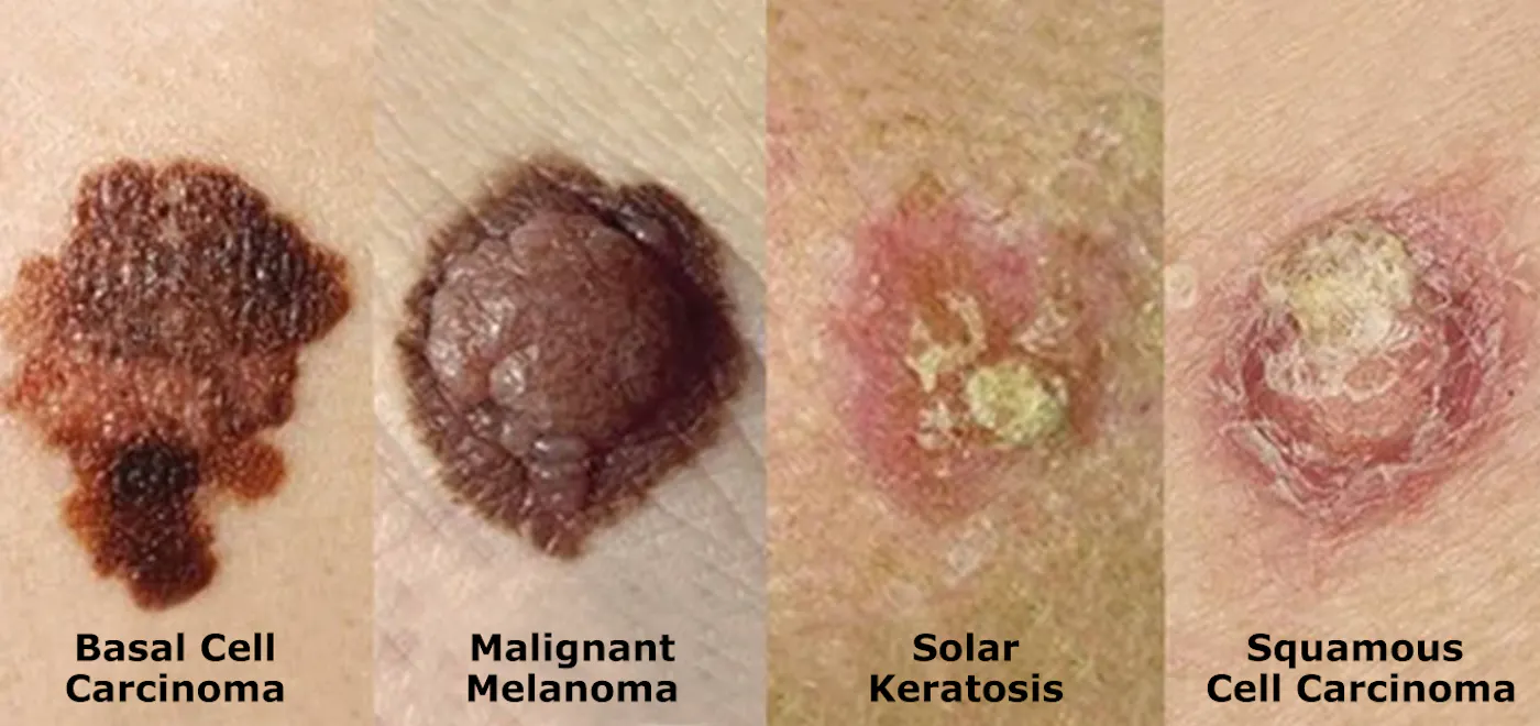 What Does Skin Cancer Look Like Anyway Healthy Delaware What Does Skin Cancer Look Like Anyway Healthy Delaware