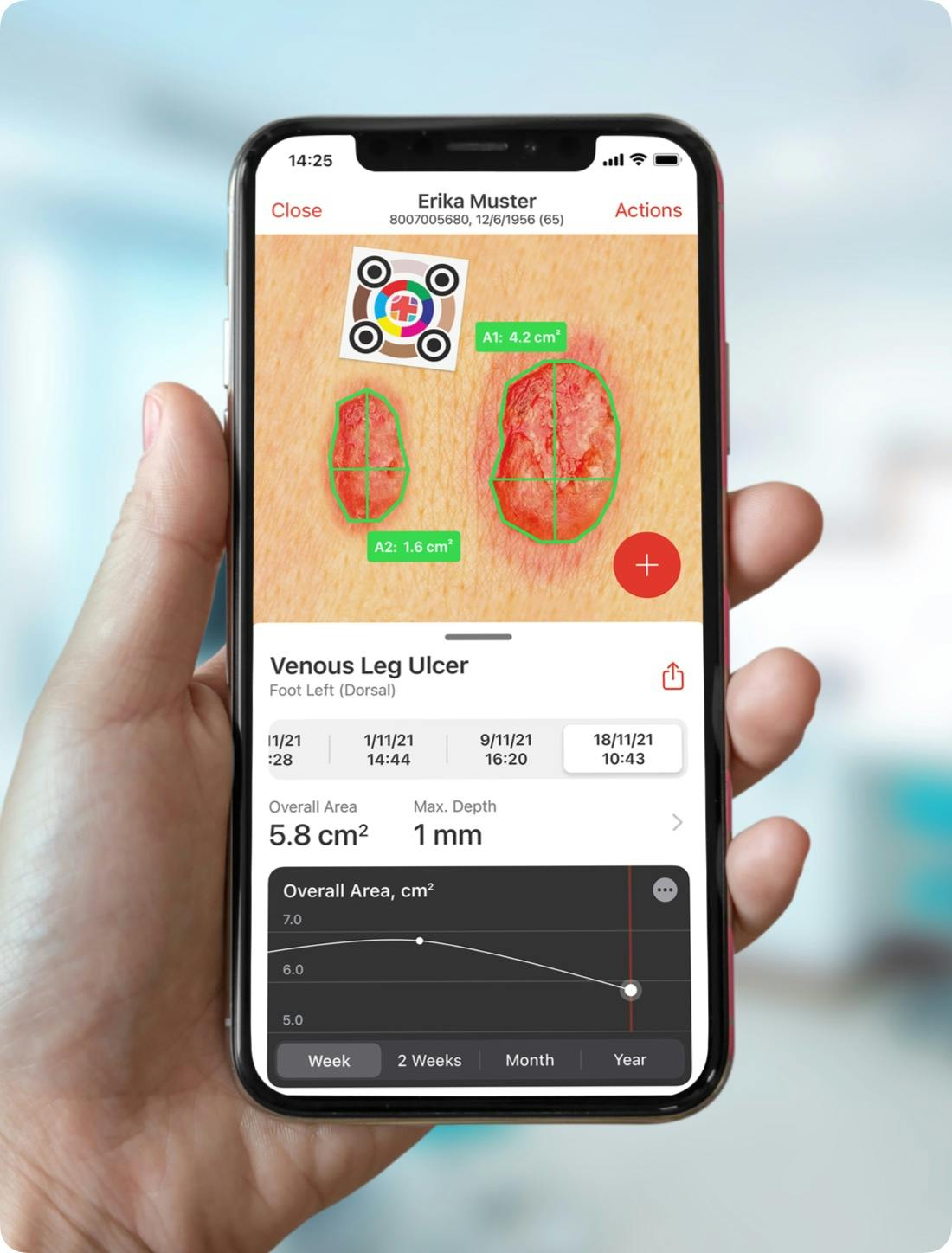 Wound measurement with imito - when to choose which measurement mode