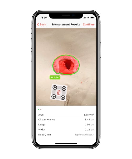 Wound measurement with imito's calibration markers