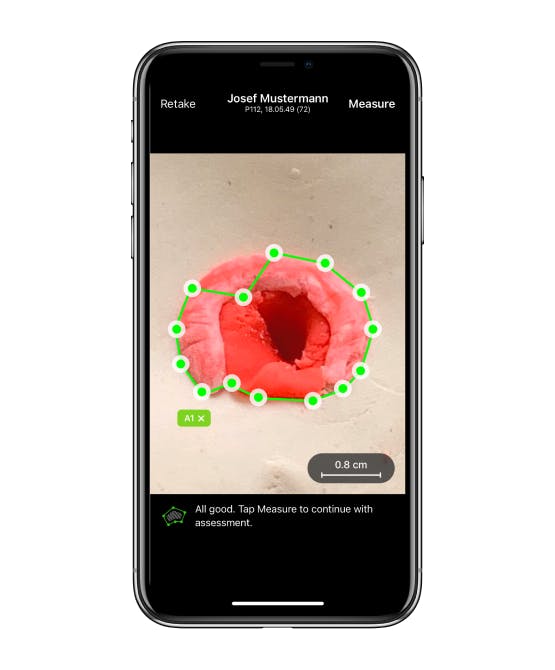Wound measurement with imito's calibration markers