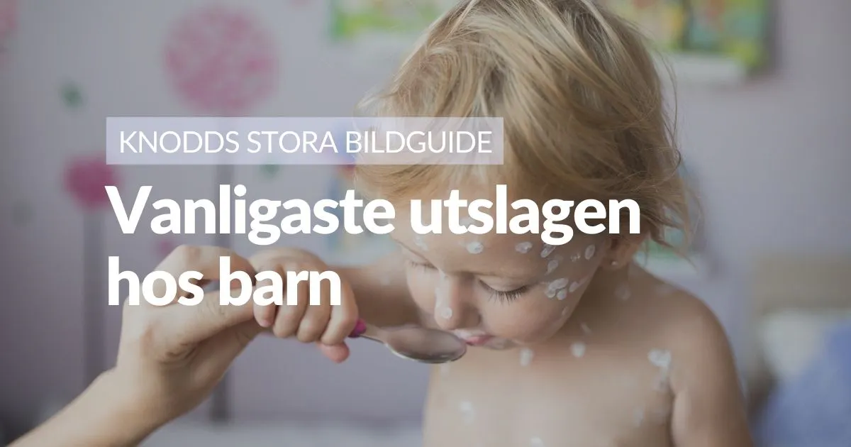 Utslag hos barn - Knodds stora bildguide | Knodd