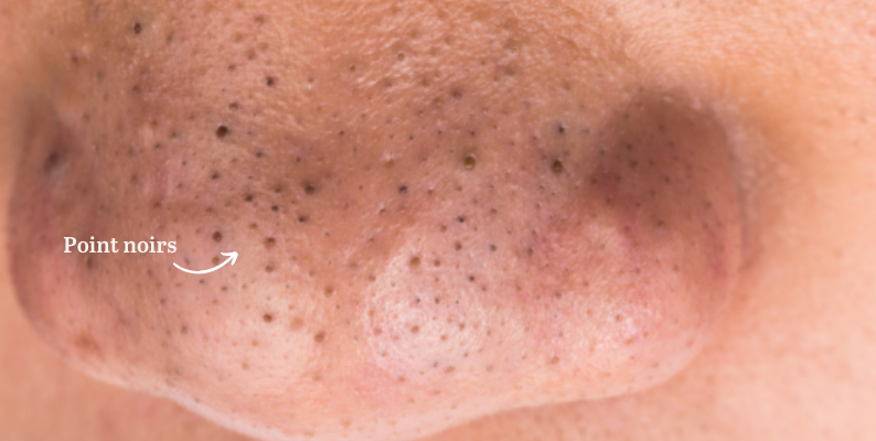 Solutions naturelles et efficaces pour enlever les points noirs