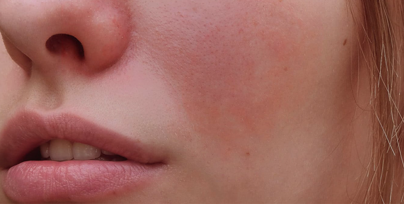 Qu’est-ce qu’une peau atopique & comment en prendre soin ? | Laboté