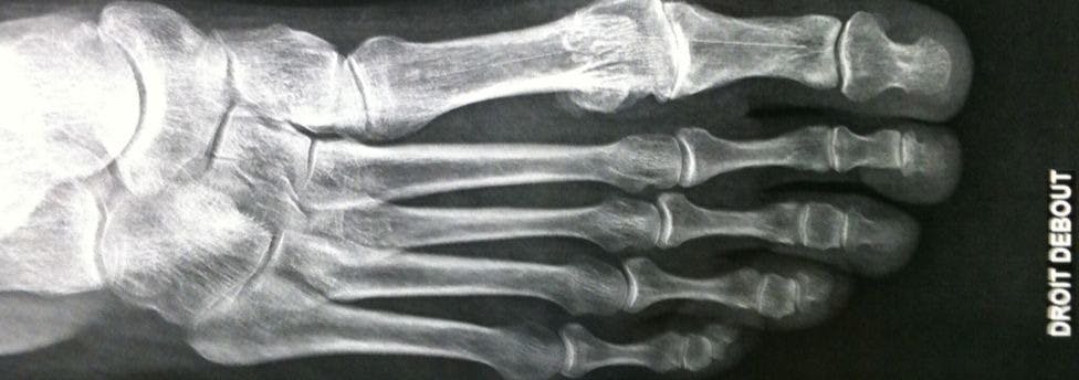 Hallux Rigidus Painful Big Toe