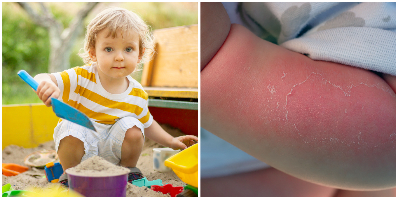 Skin cancer charity warns we must take the risk of sunburn in spring ...