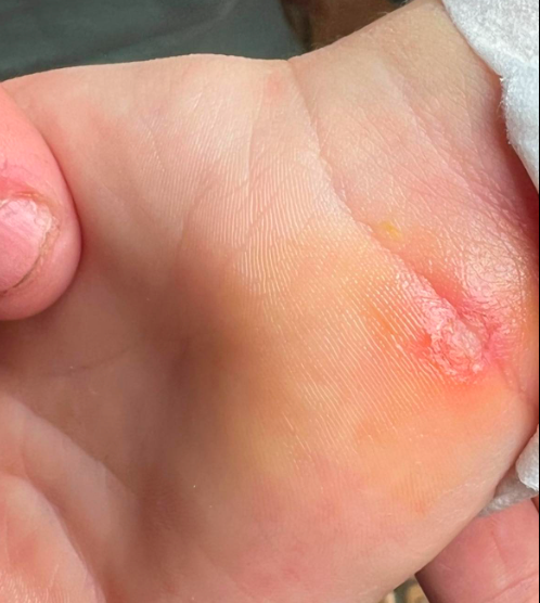 Parent's Warning To Check Your Child's 'Tiny' Cuts After Sepsis Scare ...