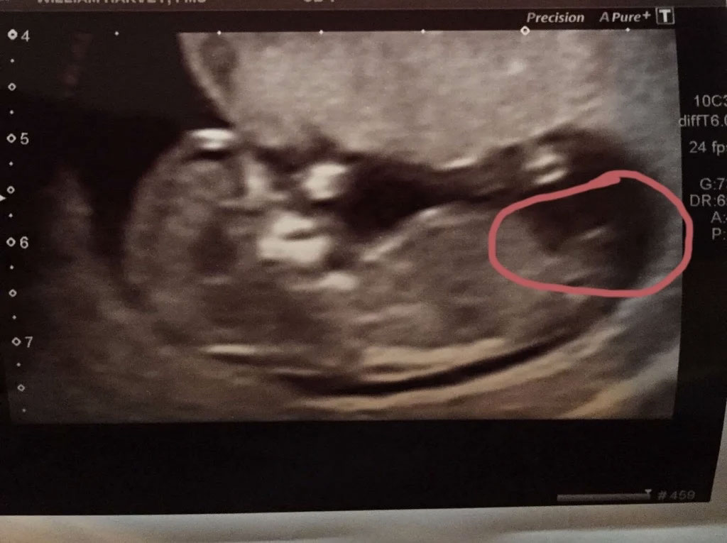 What is the nub theory? - Netmums