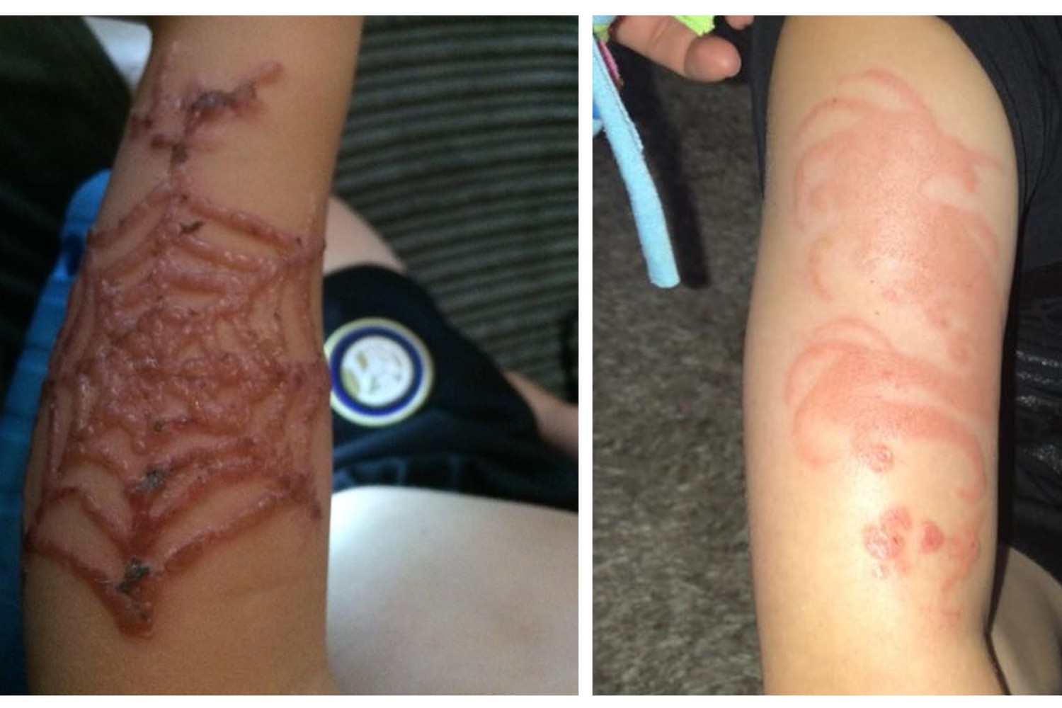 Mum’s Warning After Kids Suffer From Black Henna Chemical Burns On ...