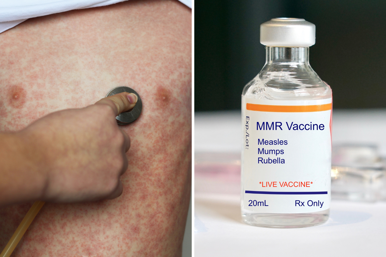 The symptoms of measles every parent needs to know - Netmums