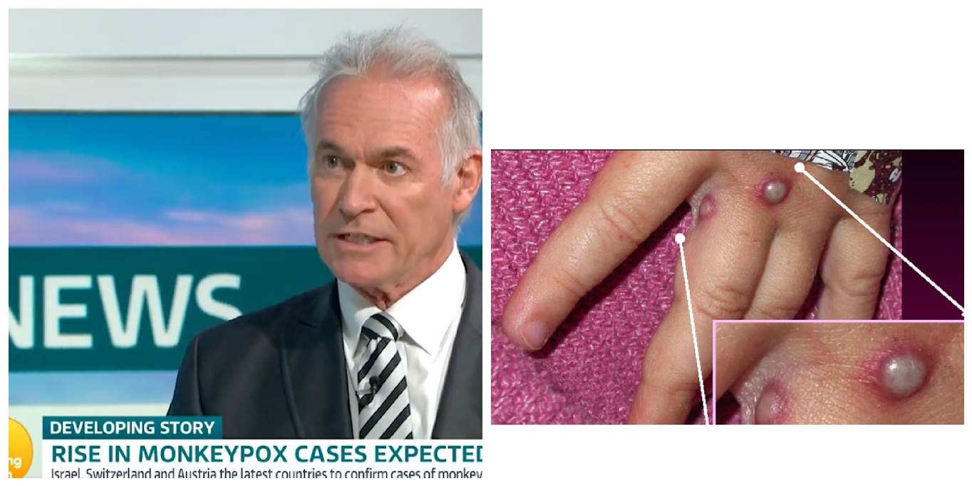 Monkeypox: Everything Parents Need To Know - Netmums