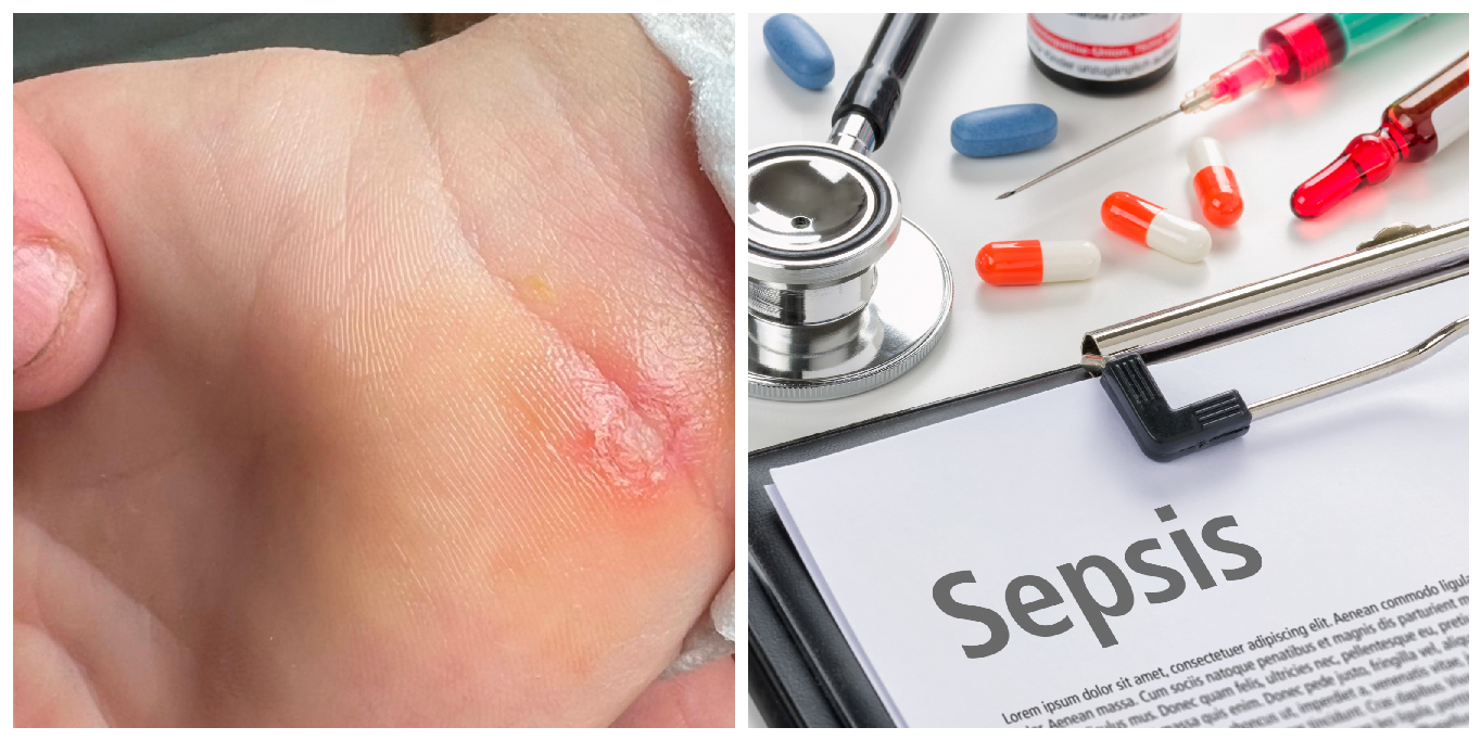 Parent's Warning To Check Your Child's 'Tiny' Cuts After Sepsis Scare ...