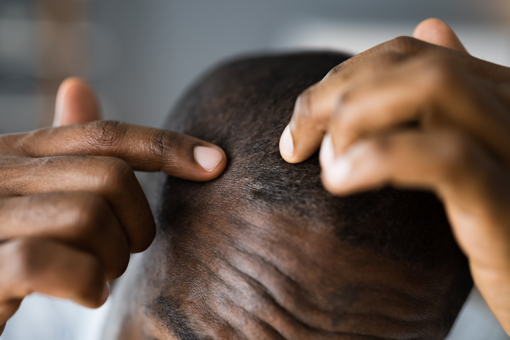 Webinar: Hard to Treat - Scalp, Face, and Ear Psoriasis