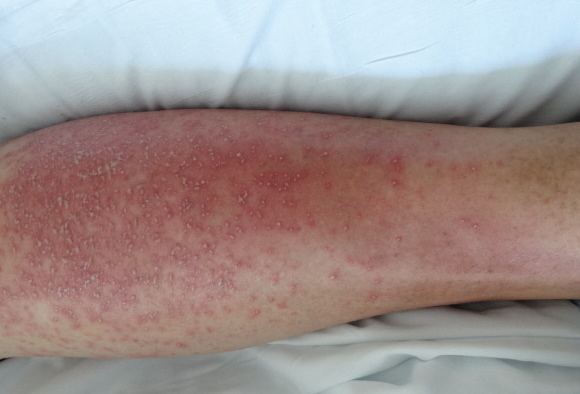 Pustular Psoriasis: Symptoms, Causes & Treatment